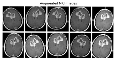 Brain Tumor Classification In Mri Image Using Convolutional Neural Network Images