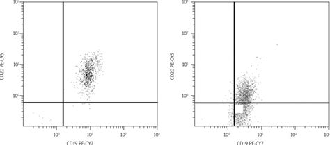 Cd19 Cd20 Expression In Leukemic Cells Sll Cells In The Left Plot And