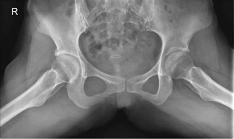 X Ray Of Her Pelvis Three Months After Surgery Frog View Showed Mild