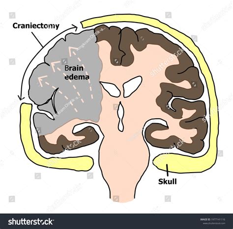 Craniectomy 149 Images Photos Et Images Vectorielles De Stock
