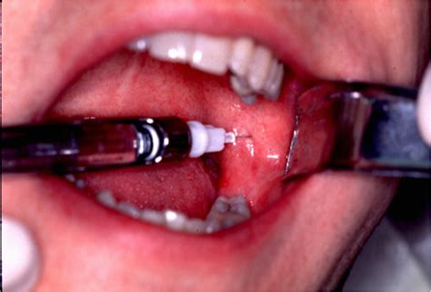 Dental Mandibular Block Technique At Thomas Schnell Blog