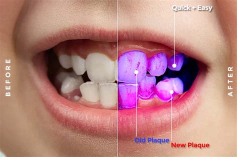 Tepe Plaqsearch™ Ten 10 Plaque Disclosing Tablets