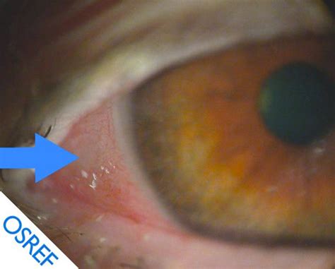 Conjunctivochalasis Eye Care In Sunnyside Ny