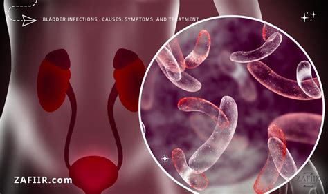 Bladder Infections Causes Symptoms And Treatment