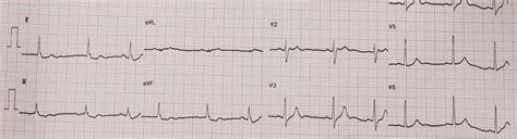 Junctional Rhythm Causes Symptoms Diagnosis And Treatment
