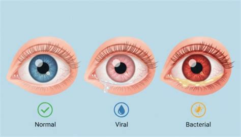 Pink Eye Vs Eye Infection 3 Signs And School Rules 2026