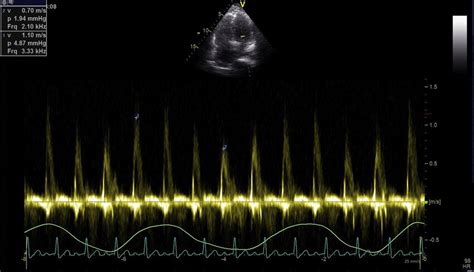 Transthoracic Echocardiography Spectral Doppler Accentuated