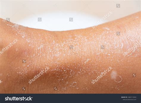 Close Human Skin Epidermis Texture Flaking Stock Photo Edit Now 1885713943