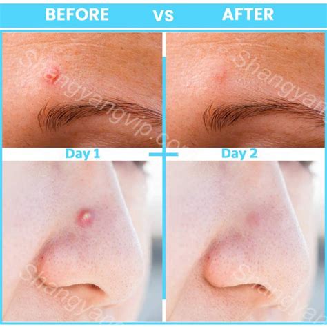 Wholesale Hydrocolloid Acne Healing Pimple Patch Acne Cover Patch