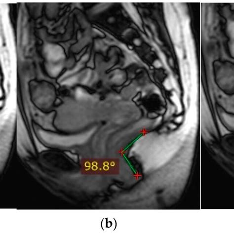 Normal Indicators Of Pelvic Organ Condition A—anorectal Angle At