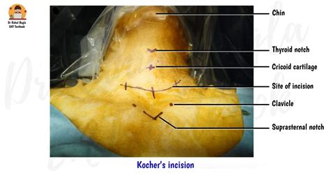 Thyroidectomy Thyroid Surgery Demystified Everything You Need To