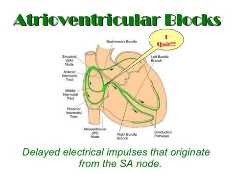 Atrioventricular Blocks Bmhtele