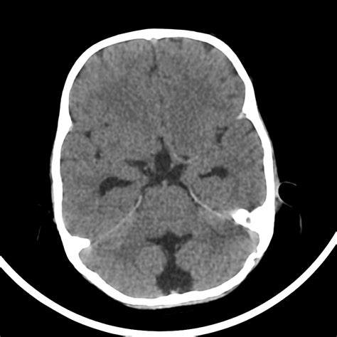 Variante De Dandy Walker Retoedu