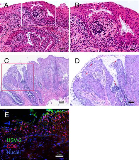 histopathology and localization of hsv 2 antigen and cd8 t cells in