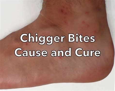 Chiggers In Shoes