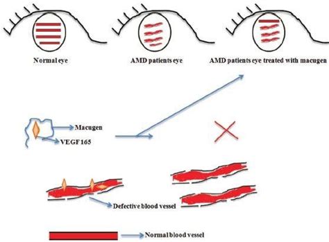 Macugen Advances In Wet Amd Research Retina Today