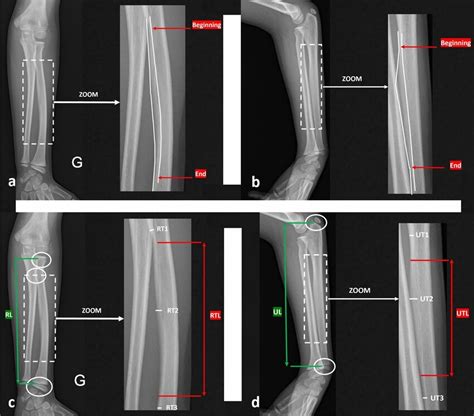 Protocol For Identification And Measurement Of Interosseous Tuberosity