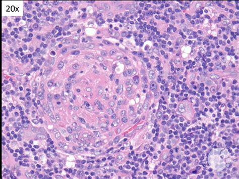 Hhv8 Positive Mcd Plasmablasts 2