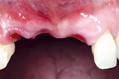 Vertical Bone Augmentation Using Tent Pole Screw Technique Prof Dr S Fickl Indication Matrix