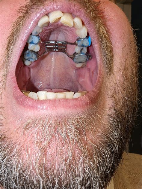 Got My Expander Placed Today Sarpe In 16 Days Rjawsurgery