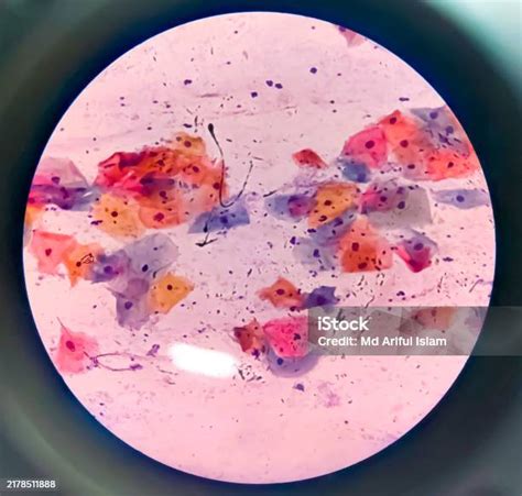 View In Microscopic Of Abnormal Human Cervix Cells Squamous Epithelium