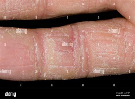 Cracked Fingers Dermatitis At Callum Balmain Blog