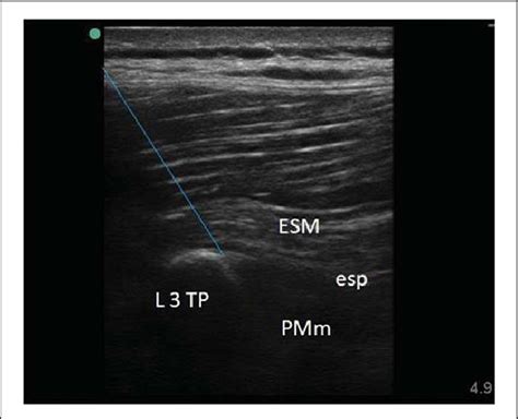 Longitudinal View Of Esp At L3 Esm Erector Spinae Muscle Esp Download Scientific Diagram