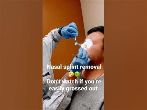 Nasal Splint Removal Septoplasty Youtube