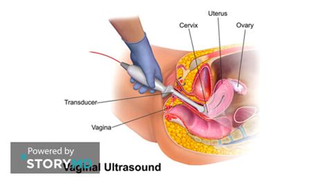 Uterus Ultrasound Procedure