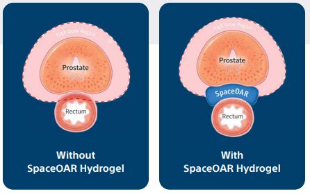 Traitement Des Effets Secondaires Du Cancer De La Prostate