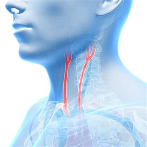 Transcarotid Artery Revascularization For High Risk Patients With