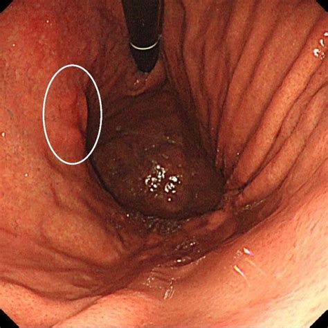 Upper Gastrointestinal Endoscopy Upper Gastrointestinal Endoscopy