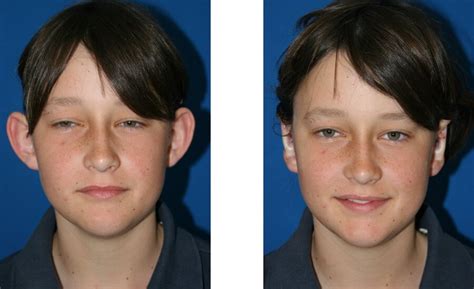 Bat Ear Correction Otoplasty Without Cutting Dr Zurek