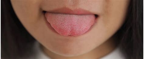 Tongue Cancer Causes And Treatment Curaprox