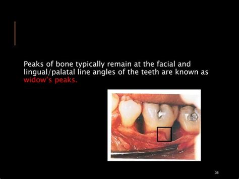 Periodontal Bone Defects Pptx Dental Health Diseases And Conditions Periodontal Bone Defects Pptx Dental Health Diseases And Conditions