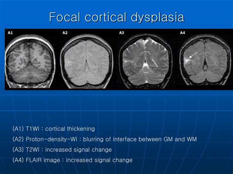 PPT Cortical Dysplasia PowerPoint Presentation Free Download ID 3412768