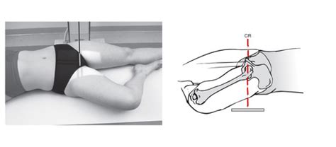 Lateral Hip Flashcards Quizlet