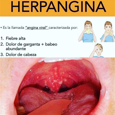 Herpangina Se Caracteriza Por Los Siguientes Síntomas ️fiebre Alta