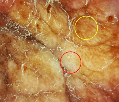 Dermoscopy Dermlite Dl4 10x Contact Polarized Mode Showed