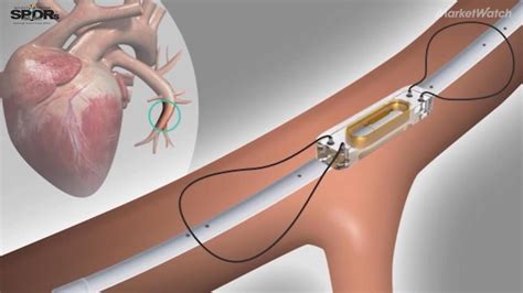 How Tech Is Reducing Hospital Readmission Rates The Courier Mail