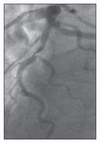 Bifurcation Lesions And Intervention Thoracic Key
