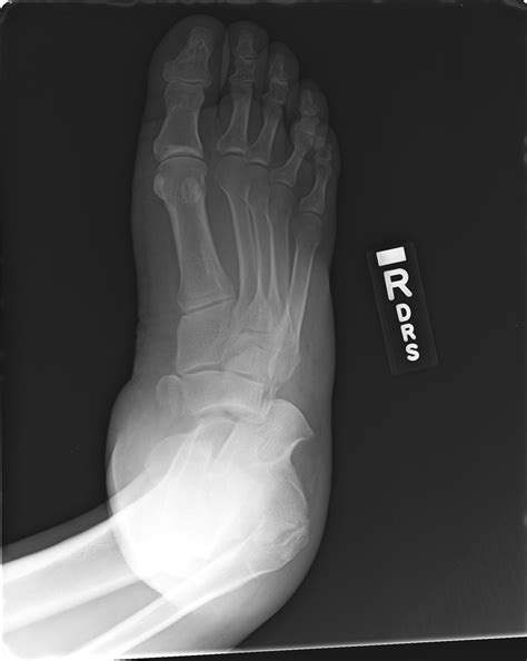 Foot Fracture Buyxraysonline