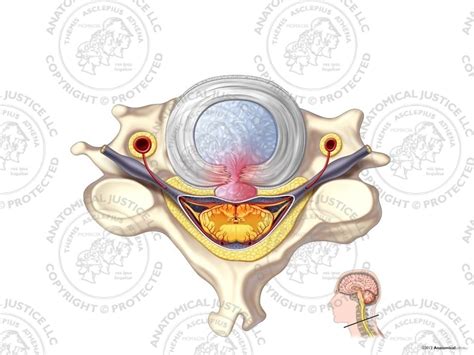 Central Cervical Disc Herniation No Text