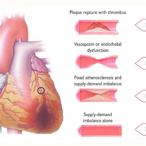 In Clinical Trials Of Mi Types According To Multiples Of The 99th