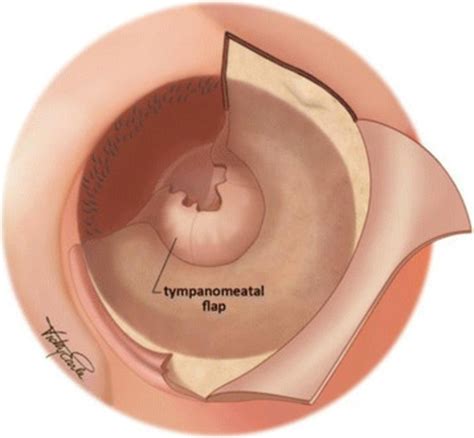 Cuff Shape Tympanomeatal Flap Legend A Cuff Shape Medial Download Scientific Diagram