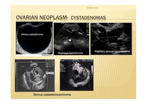 Asymptomatic Palpable Adnexal Masses Ultrasound Evaluation Warda Ppt