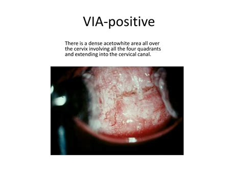 Ppt Visualization Of The Cervix With Acetic Acid And Lugols Iodine