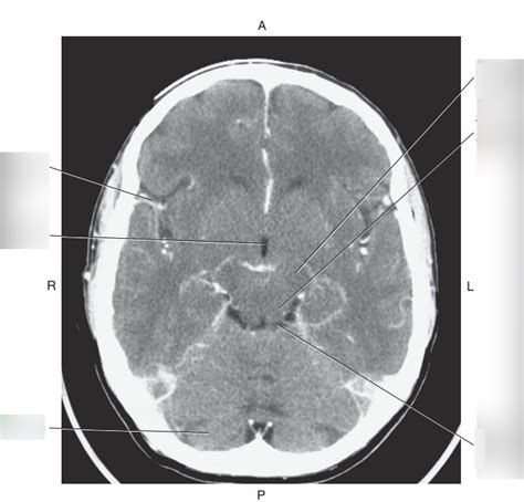 3 65 Axial Ct Of Cerebral Peduncles And Tectum Diagram Quizlet