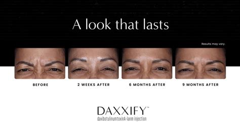 Daxxify Orange County 4 Month Wrinkle Relaxer At Plump Medical Spa
