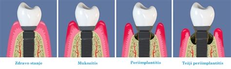 Periimplantitis Dr Matej Kulis